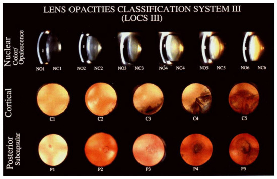 Towards a Connected Mobile Cataract Screening System: A Future Approach