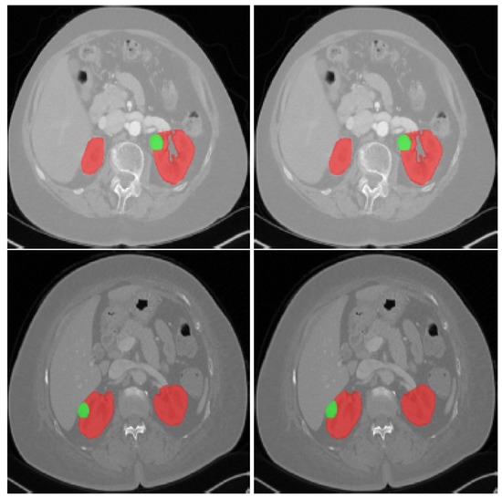 J. Imaging | Free Full-Text | Kidney Tumor Semantic Segmentation Using ...