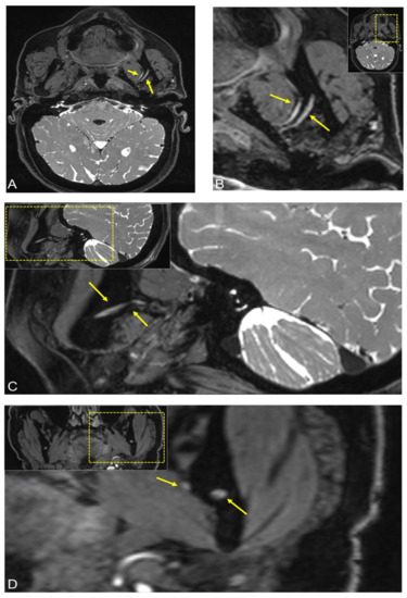 Visualization of Inferior Alveolar and Lingual Nerve Pathology by 3D ...