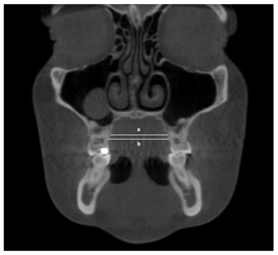 Transverse Analysis of Maxilla and Mandible in Adults with Normal ...