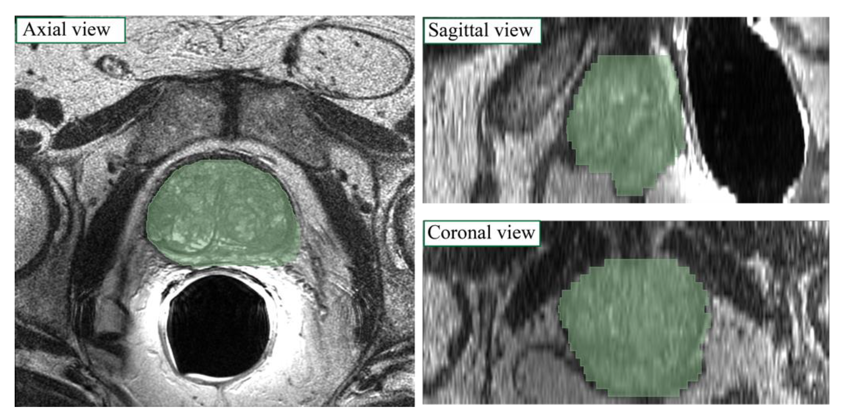 Integration of Deep Learning and Active Shape Models for More Accurate Prostate Segmentation in ...