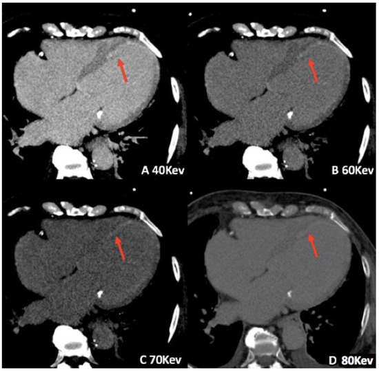 Dual-Energy CT of the Heart: A Review