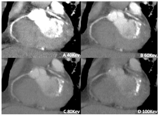 Dual-Energy CT of the Heart: A Review