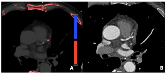 Dual-Energy CT of the Heart: A Review