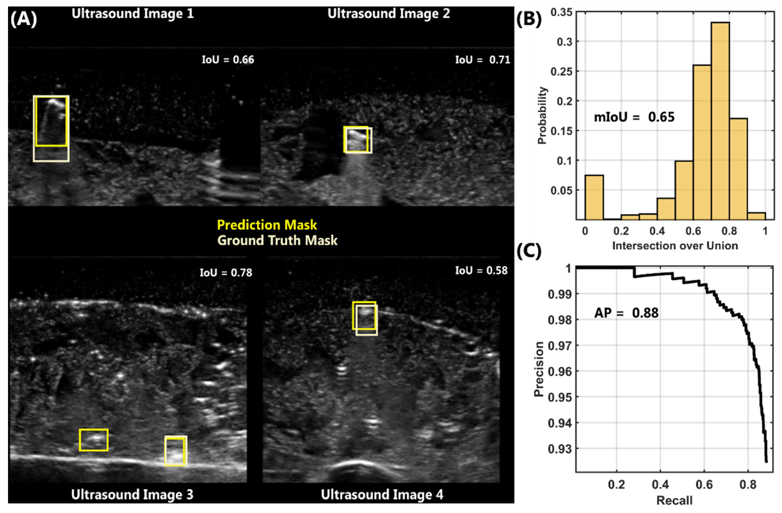 Evaluation of an Object Detection Algorithm for Shrapnel and Development of a Triage Tool to ...