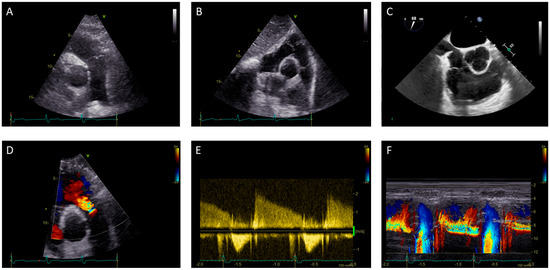 Multimodality Imaging of the Neglected Valve: Role of Echocardiography ...