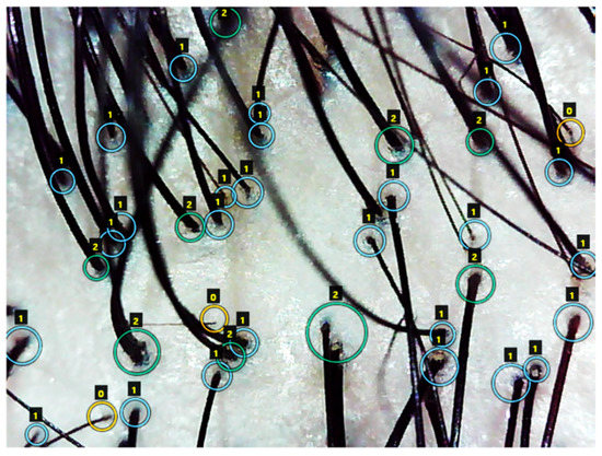 Hair Follicle Classification and Hair Loss Severity Estimation Using ...