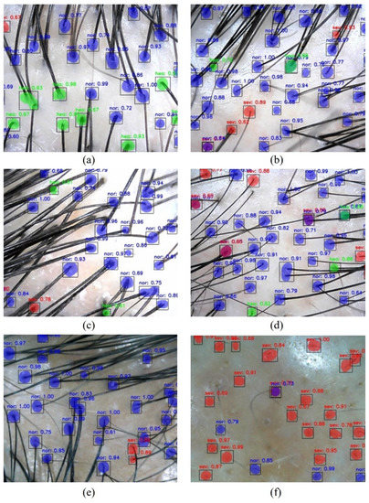 Hair Follicle Classification and Hair Loss Severity Estimation Using ...