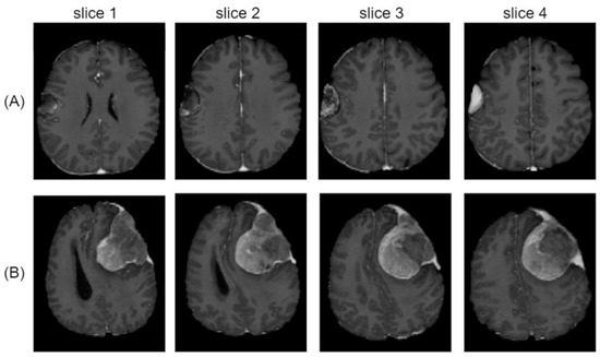 Fully Automated Segmentation Models of Supratentorial Meningiomas Assisted by Inclusion of ...