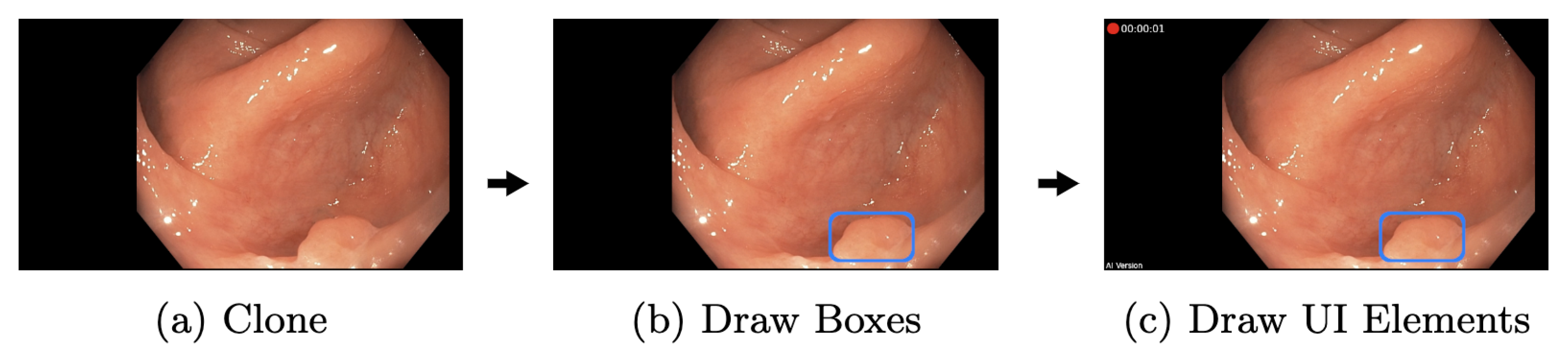 A Real-Time Polyp-Detection System with Clinical Application in Colonoscopy Using Deep ...