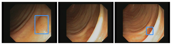 A Real-Time Polyp-Detection System with Clinical Application in ...