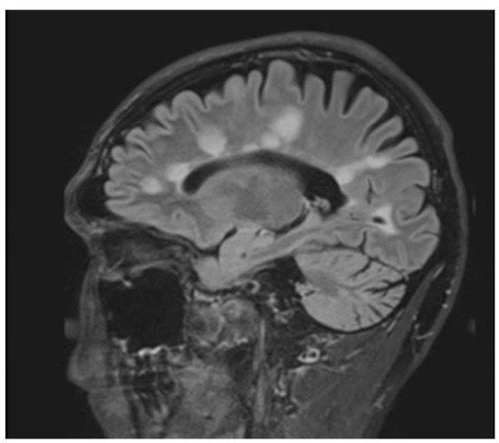 Brain and Spinal Cord MRI Findings in Thai Multiple Sclerosis Patients