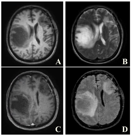 Brain and Spinal Cord MRI Findings in Thai Multiple Sclerosis Patients