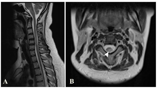 Brain and Spinal Cord MRI Findings in Thai Multiple Sclerosis Patients