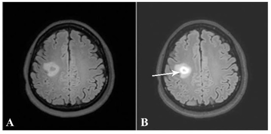 Brain and Spinal Cord MRI Findings in Thai Multiple Sclerosis Patients
