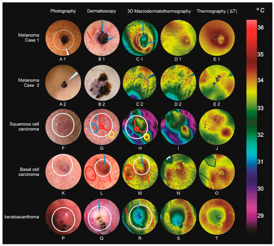 Infrared Macrothermoscopy Patterns—A New Category of Dermoscopy