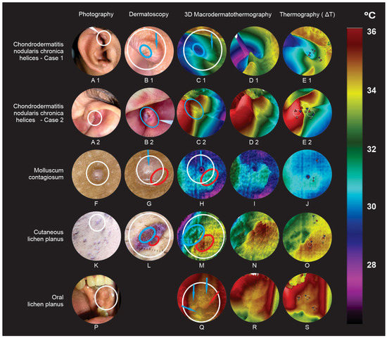 Infrared Macrothermoscopy Patterns—A New Category of Dermoscopy