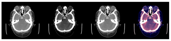 Deep Learning Applied to Intracranial Hemorrhage Detection
