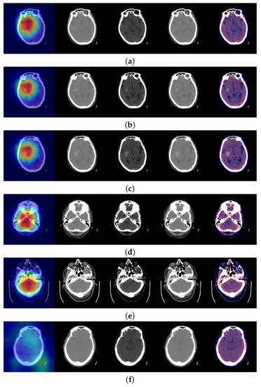 Deep Learning Applied to Intracranial Hemorrhage Detection