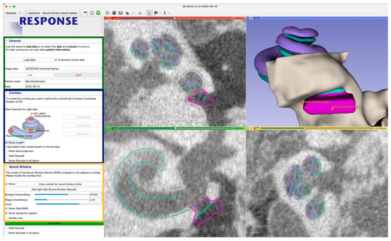 Development and In-Silico and Ex-Vivo Validation of a Software for a Semi-Automated Segmentation ...