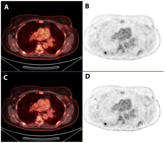 Comparison of Image Quality and Quantification Parameters between Q.Clear and OSEM ...