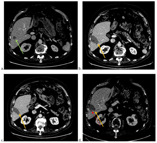 Predictive Factors of Local Recurrence after Colorectal Cancer Liver ...