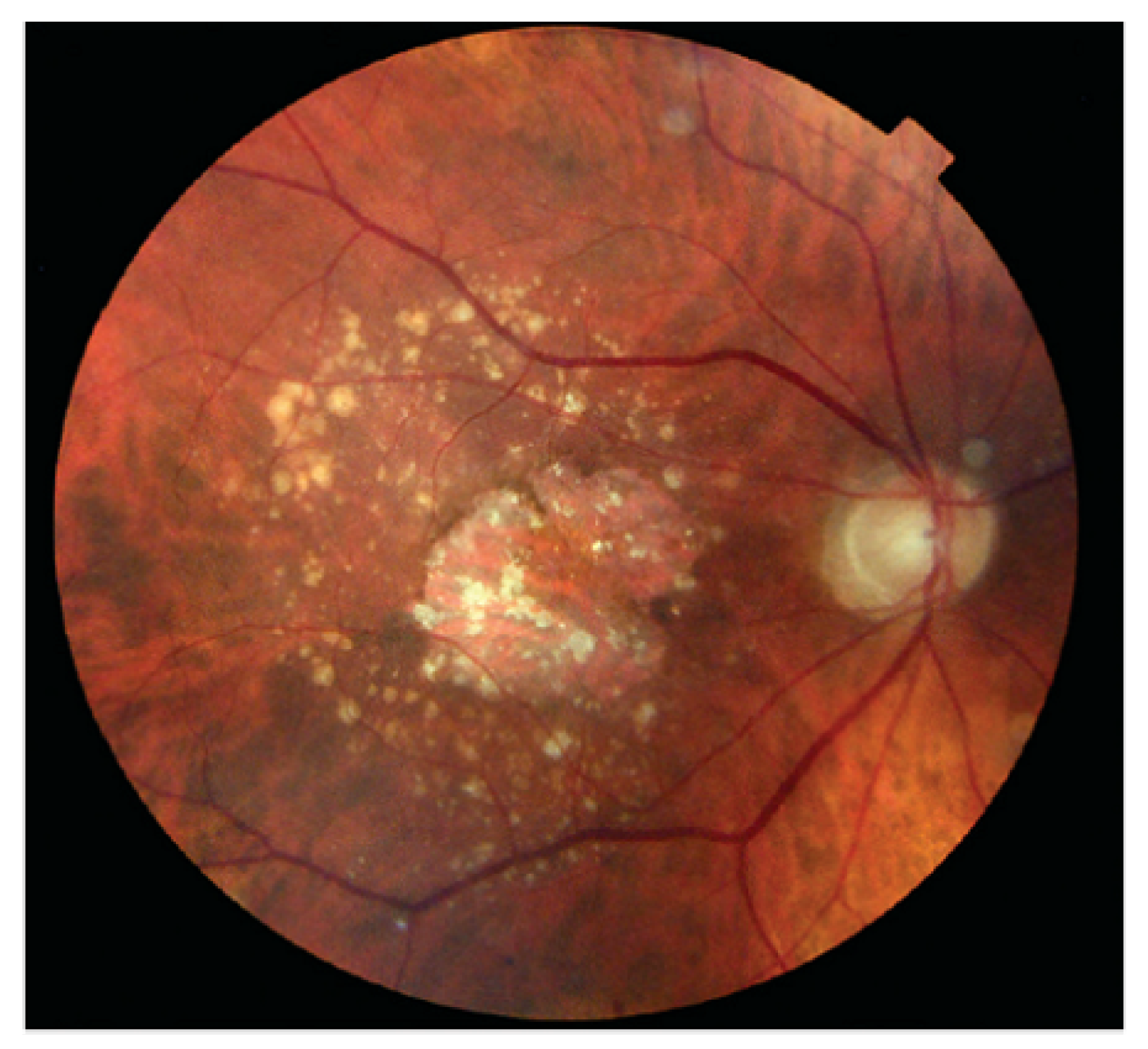 Retinal Disease Detection Using Deep Learning Techniques: A ...