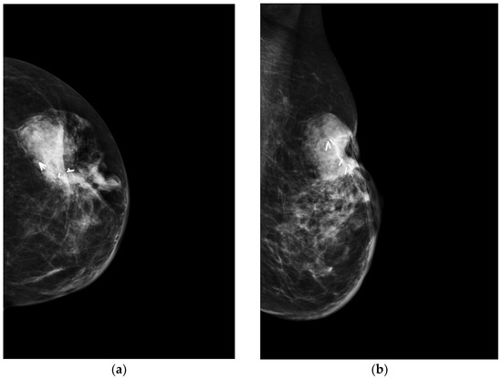 Angiosarcoma of the Breast: Overview of Current Data and Multimodal ...