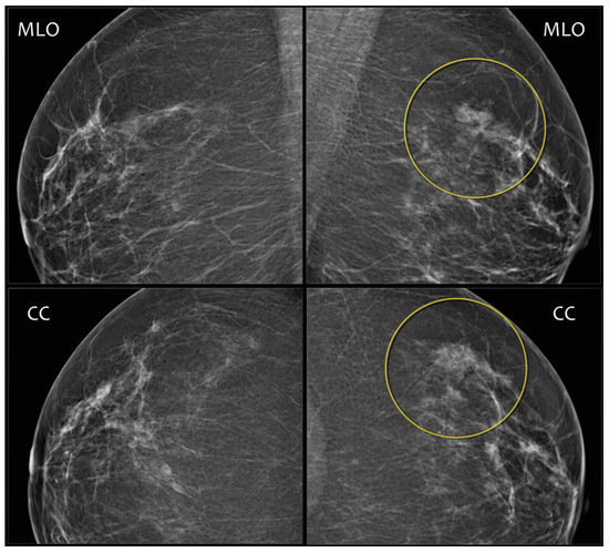 Mammography Datasets for Neural Networks—Survey