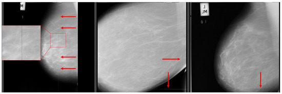 Mammography Datasets for Neural Networks—Survey