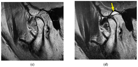 Examination for the Factors Involving to Joint Effusion in Patients ...