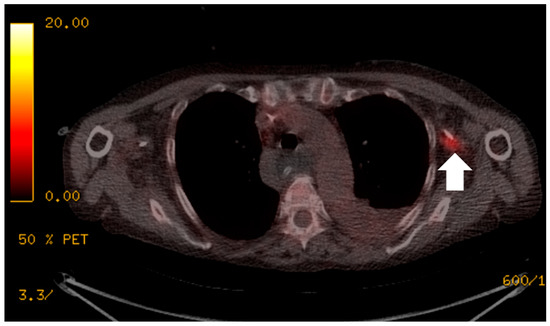 Clinical Utility of 18Fluorodeoxyglucose Positron Emission Tomography ...