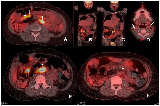 Clinical Utility of 18Fluorodeoxyglucose Positron Emission Tomography ...