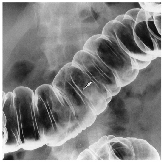 Imaging of Gastrointestinal Tract Ailments