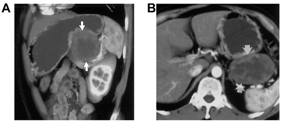Imaging of Gastrointestinal Tract Ailments