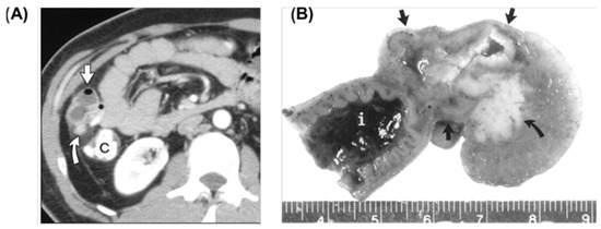 Imaging of Gastrointestinal Tract Ailments