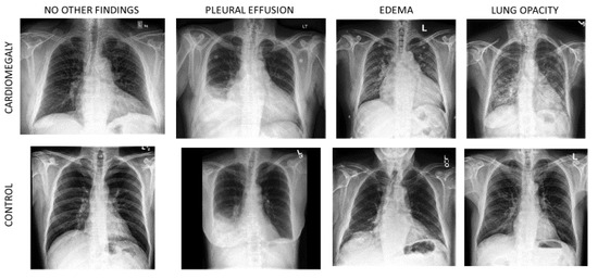 Hybrid Classical–Quantum Transfer Learning for Cardiomegaly Detection ...