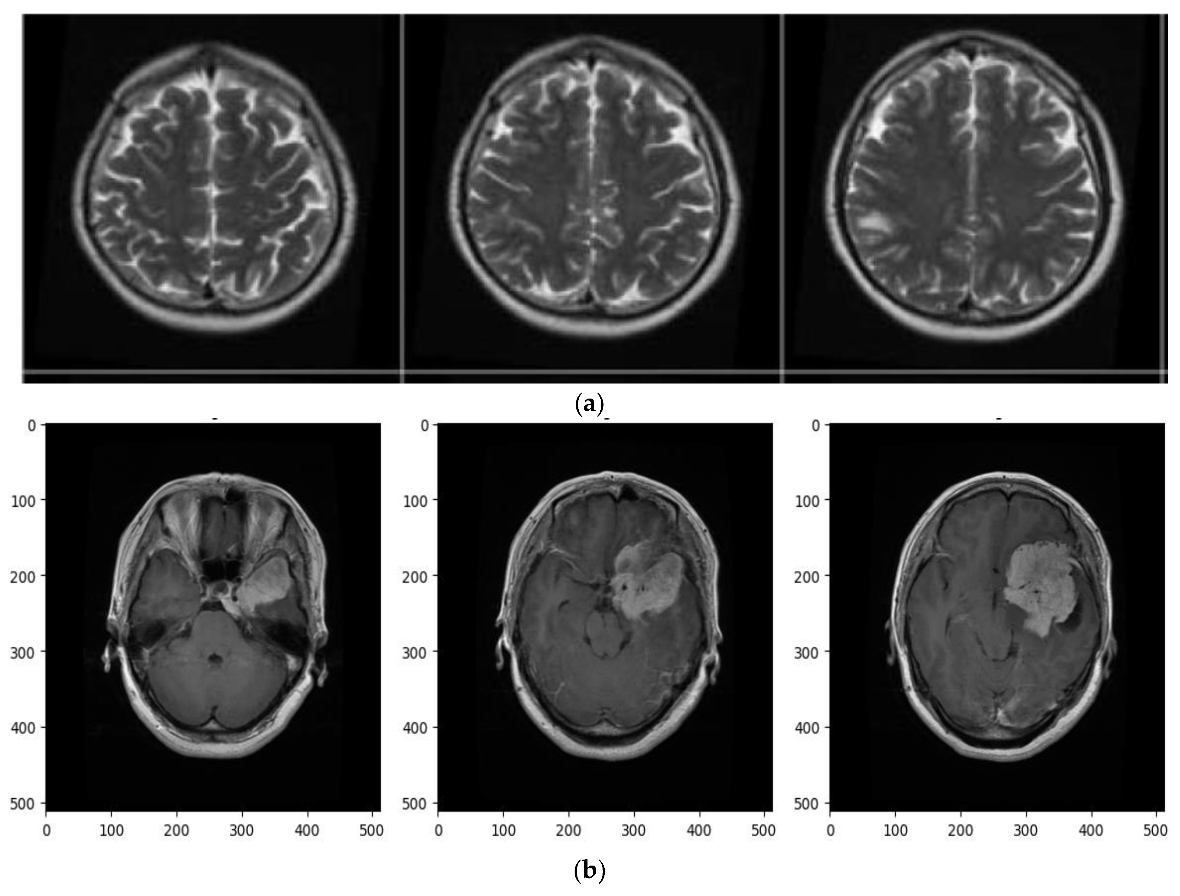 MRI-Based Effective Ensemble Frameworks for Predicting Human Brain Tumor
