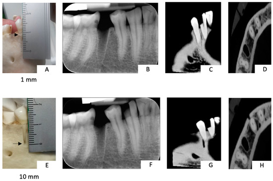 Accuracy of Intra-Oral Radiography and Cone Beam Computed Tomography in ...