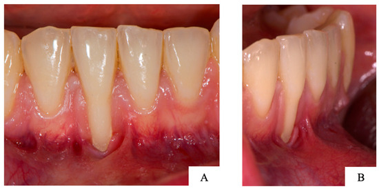 Accuracy of Intra-Oral Radiography and Cone Beam Computed Tomography in ...