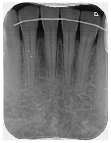 Accuracy of Intra-Oral Radiography and Cone Beam Computed Tomography in ...