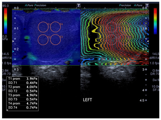 Testicular Evaluation Using Shear Wave Elastography (SWE) in Patients ...
