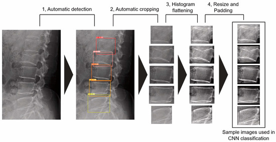 A Deep Learning-Based Model for Classifying Osteoporotic Lumbar ...