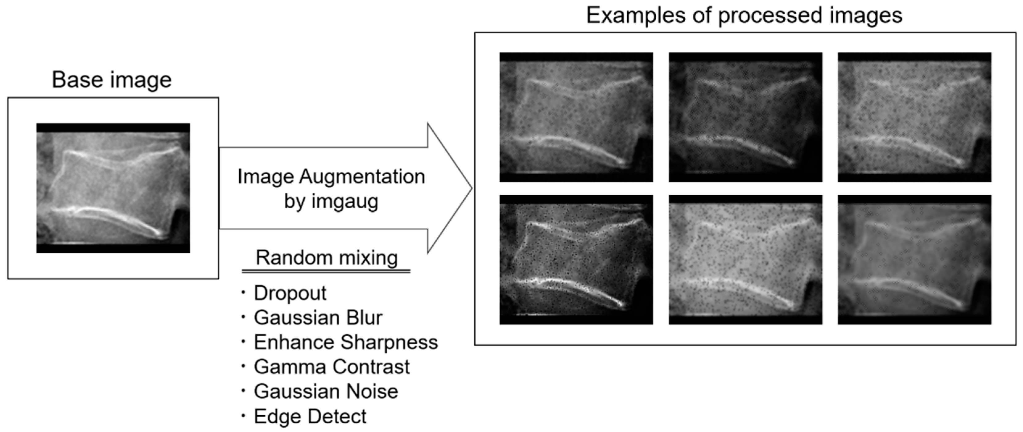 A Deep Learning-Based Model for Classifying Osteoporotic Lumbar Vertebral Fractures on ...