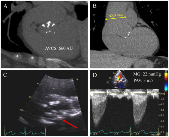 Aortic Valve Calcium Score by Computed Tomography as an Adjunct to ...