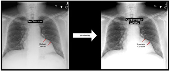 WindowNet: Learnable Windows for Chest X-ray Classification