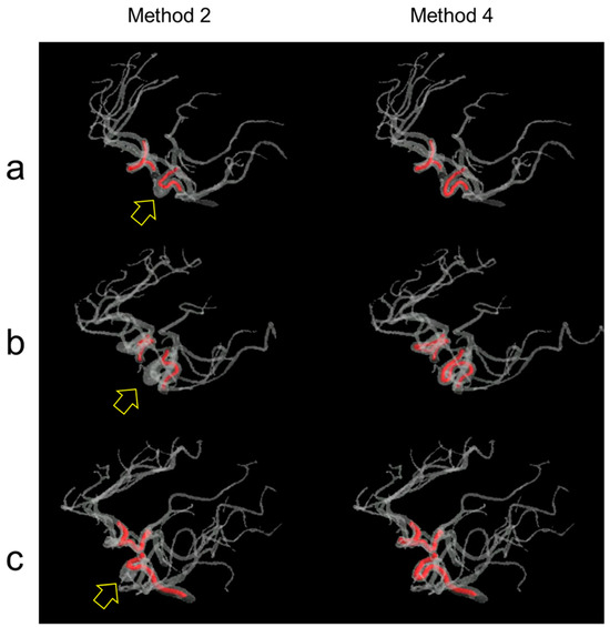 An Improved Path-Finding Method for the Tracking of Centerlines of ...