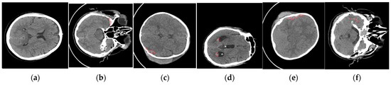 An Efficient CNN-Based Method for Intracranial Hemorrhage Segmentation ...