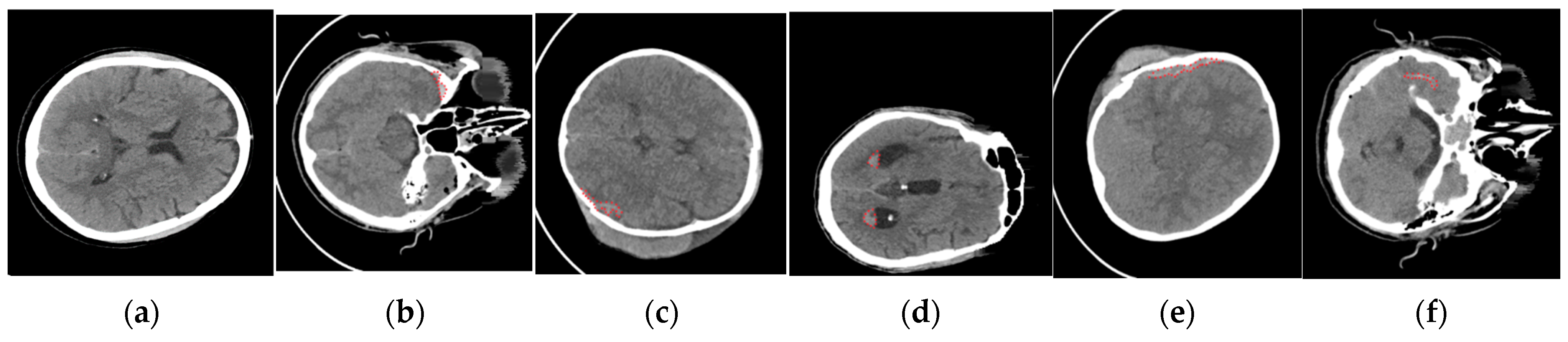 An Efficient CNN-Based Method for Intracranial Hemorrhage Segmentation from Computerized ...