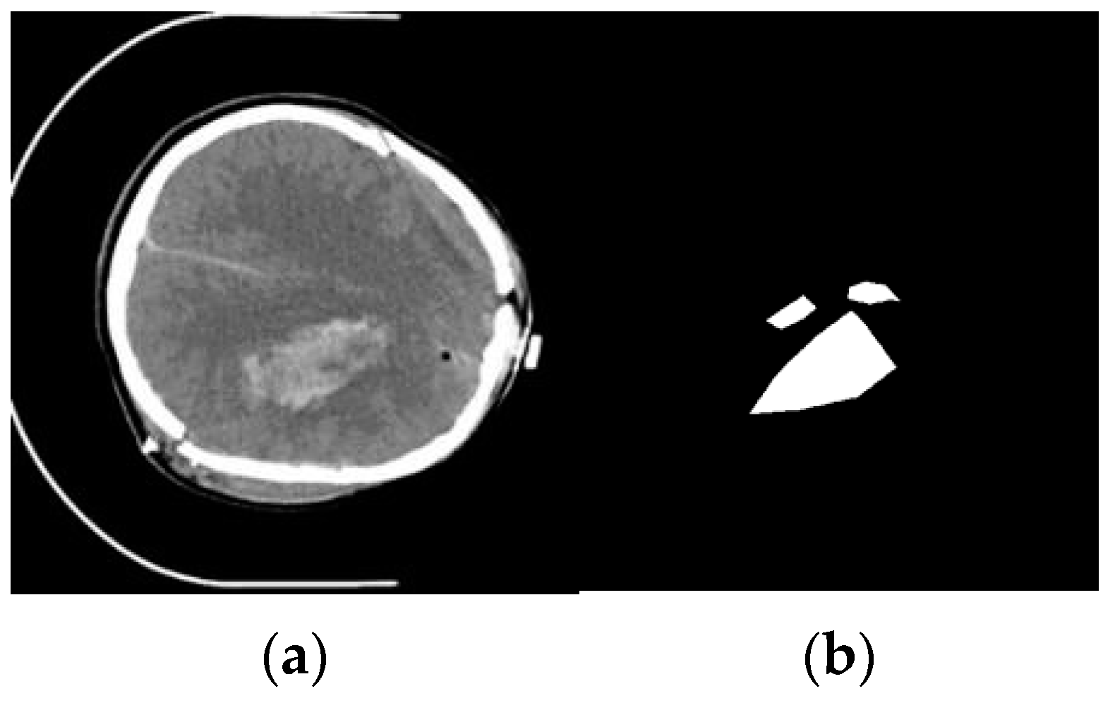 An Efficient CNN-Based Method for Intracranial Hemorrhage Segmentation ...